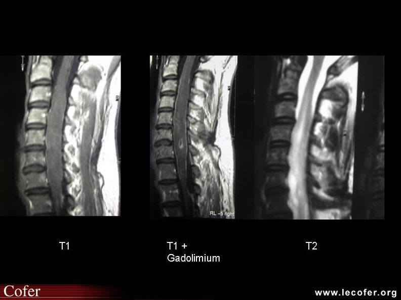 Astrocytome Cervical Diapoth que Du COFER Astrocytome Cervical Diapoth que Du COFER